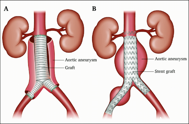 Aortic Artery Aneurysm & Dissection Treatment in Amman, Jordan | Dr ...