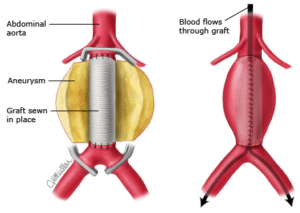 Aortic Artery Aneurysm & Dissection Treatment in Amman, Jordan | Dr ...